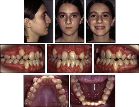 Nonextraction Treatment Of A Skeletal Class Iii Adolescent Girl With