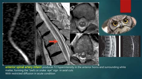 Spinal Cord Disorderspptx