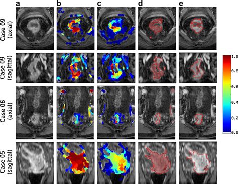 2d Cross Sections Of The 3d Automatic Segmentations Of Rectal Dce Mri