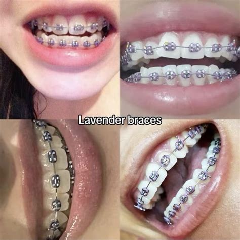 Pin By Yuli On Ваши пины Getting Braces Braces Colors Dental Braces