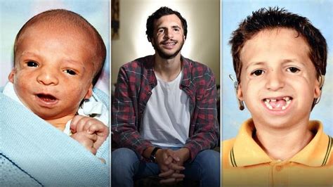 Treacher Collins Syndrome Before And After Becky Zingale Shares How