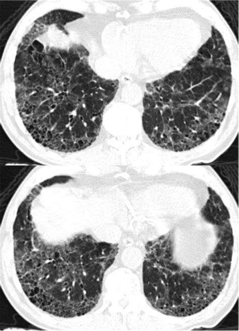 Traction Bronchiectasisbronchiolectasis Is Associated With
