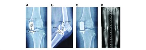 Radiological Measures Of The Prosthesis After Uka A Valgus Varus