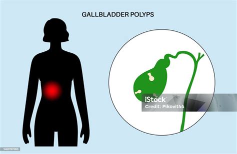 Gallbladder Polyp Anatomy Stock Illustration Download Image Now Abdomen Adult Alertness