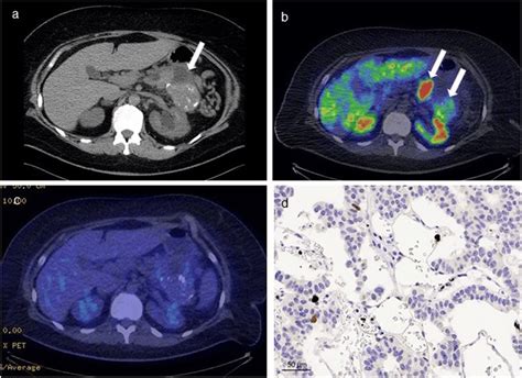 A 32 Year Old Female Patient Had A 10 Cm Complex Cystic Solid Mass In
