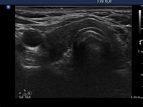 Parathyroid Lesions