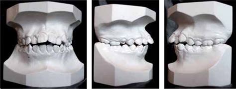 Fifteen Months Of Treatment With Tip Edge System Of A Class Ii Division