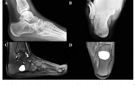 Unicameral Bone Cyst Semantic Scholar