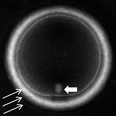 Different Human Oocyte Morphological Abnormalities Arrows Observed By Download Scientific