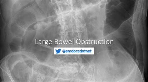 Emergency Medicine Educationlarge Bowel Obstruction Ed Presentation Evaluation