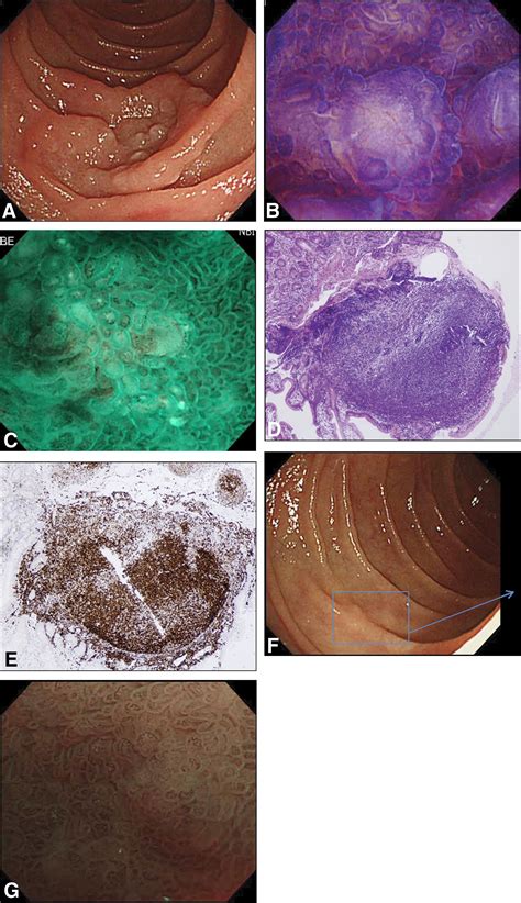 Case Series Of Duodenal Follicular Lymphoma Observed By Magnified