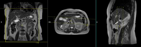 Mrcp Planning Mrcp Protocols Indications For Mri
