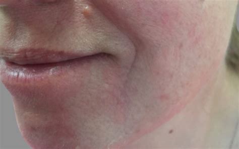 Nasolabial Folds And Smile Lines Treatment Perth Dermedica