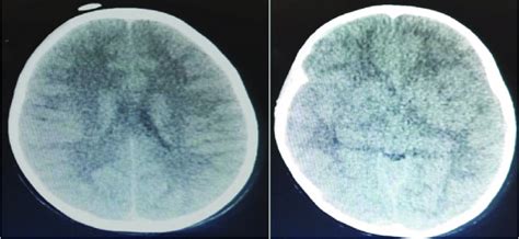 Brain Ct Scan Revealing Mild Sulcal Effacement Download Scientific