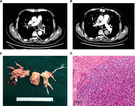 Frontiers Outcomes Of Pulmonary Endarterectomy For Patients With