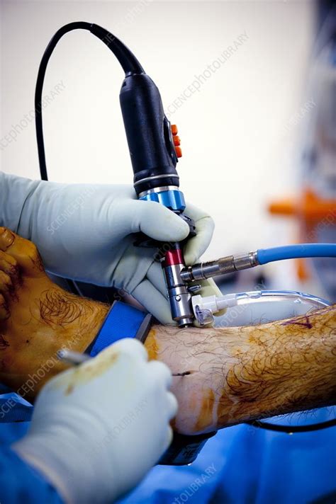 Ankle Arthroscopy Stock Image C0085203 Science Photo Library