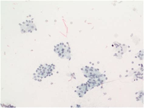 Successful Preoperative Diagnosis Of Heterotopic Pancreas In The