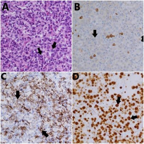 An Advanced Aids Patient With Cd4