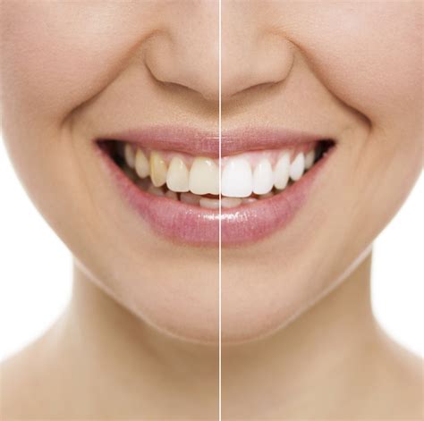 Composite Bonding Guide Fix Teeth Stains Gaps Shape And More