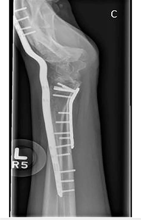 Lateral Radiograph After The First Stage Of Surgery Length Alignment Download Scientific