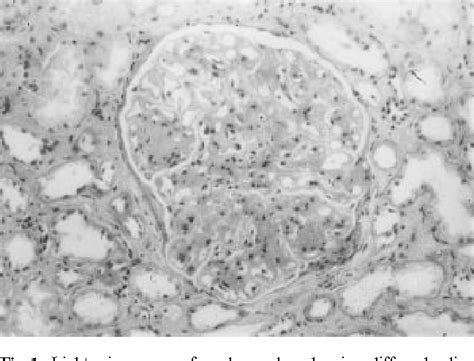 Figure 1 From Nodular Glomerulosclerosis After Renal Transplantation