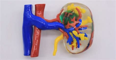 남성환자가 2배 많은 신장암 초기증상 거의 없어부분절제술 주목