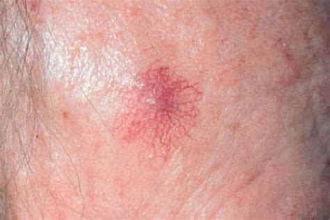 Mole And Warts Removal Impression Beauty
