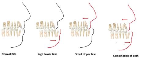 Underbite Types And Correction Treatment And How To Choose
