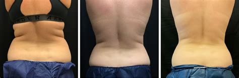 Coolsculpting In Atlanta Dermatology Center Of Atlanta