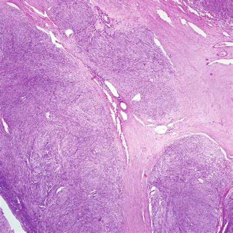Computerized Tomography An Enlarged Prostate Showing Calcifications