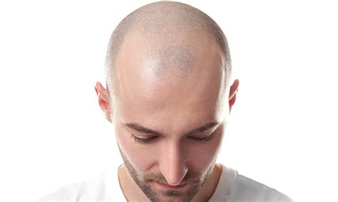Bad Hairline Men