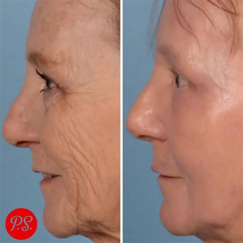 Phenol Peel Before And After Before After Journey