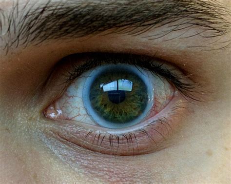 Keratoconus Seeing The World Through My Eyes Keratoconus Group