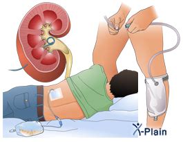 Nephrostomy Tube Care