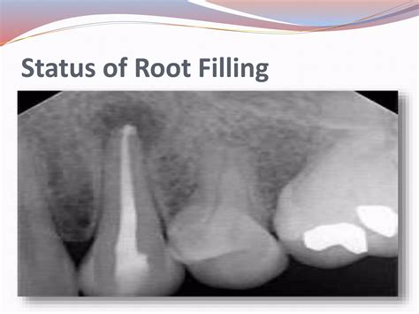 Parallel Angle Technique Vs Bisecting Angle Technique Pptx