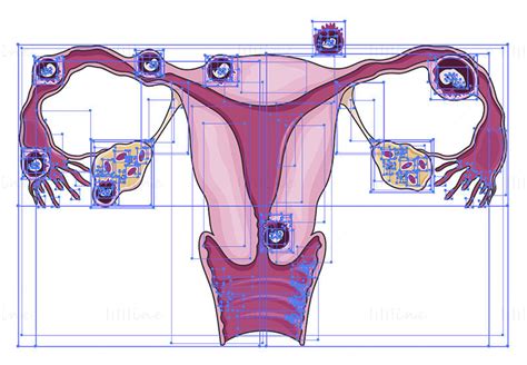 Ectopic Pregnancies Vector Illustration