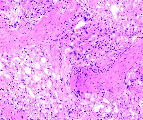 Pathology Outlines Rhabdomyoma