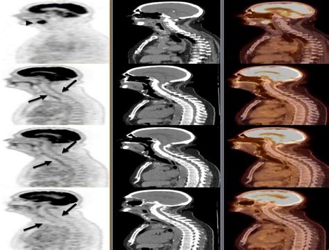 A 72 Year Old Male Patient With Right Pyriform Sinus Scc A Baseline