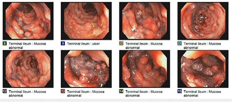 Colonoscopy Showing Features Of Terminal Ileitis Download Scientific Diagram