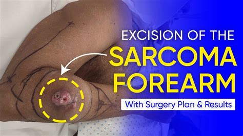 Sarcoma Excision Of Forearm Sarcoma Excision With Surgery Plan And