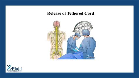 Release Of Tethered Cord Youtube