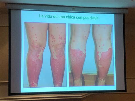Lanzan Un Nuevo Tratamiento Para La Psoriasis Severa Que La Elimina En Forma Total Infobae