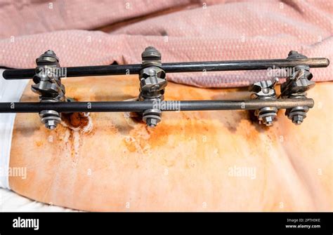 Above View Of External Fixation Device On Hip And Pelvic In Patient