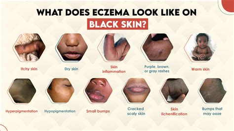 Eczema On Black Skin Is It Different Happy Cappy