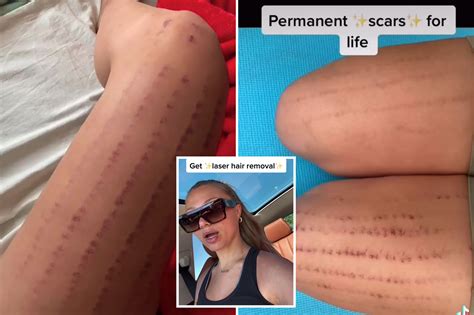 Can You Workout After Laser Hair Removal Ga Fashion