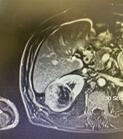 Thuchchai Pipitpanpipit On Linkedin Q Partial Vs Radical Nephrectomy Me Partial Nephrectomy