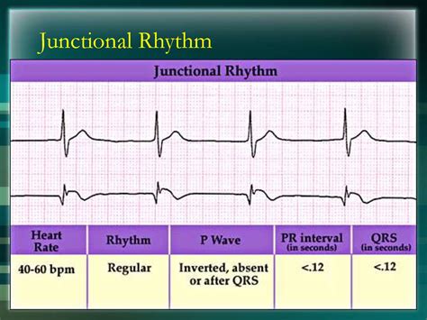 Basics Of Ecg Online Presentation