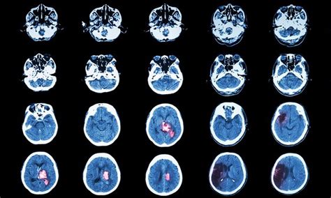 Electrical Brain Stimulation Could Boost Benefits Of Stroke Rehabilitation Science Awareness