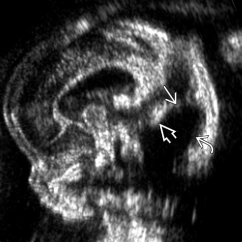 Dandy Walker Malformation Radiology Key