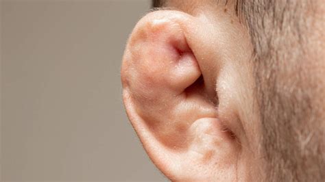 What Is Cauliflower Ear Causes Prevention And Protection For Mma